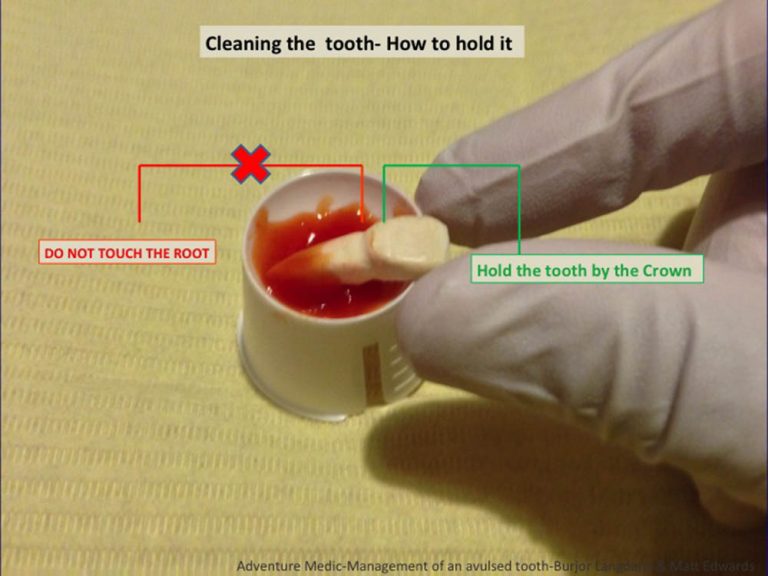 What To Do If I Get My Front Tooth Knocked Out? ( Front Tooth Broken ...