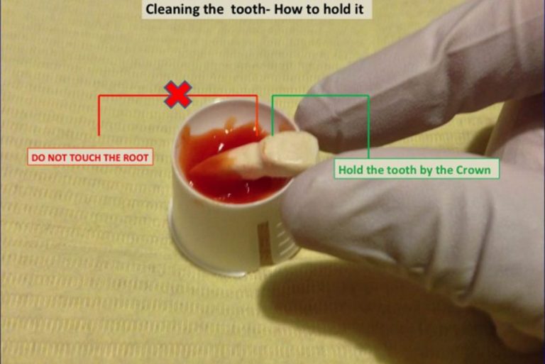 What To Do If I Get My Front Tooth Knocked Out? ( Front Tooth Broken ...